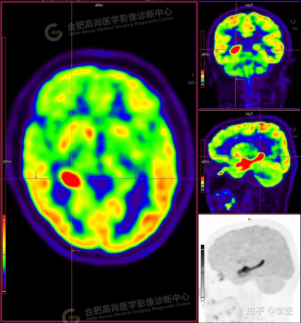 18F－FDG PET/CT检查发现自身免疫性脑炎 - 知乎