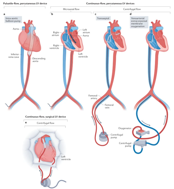 机械循环辅助装置进展及应用 - 知乎