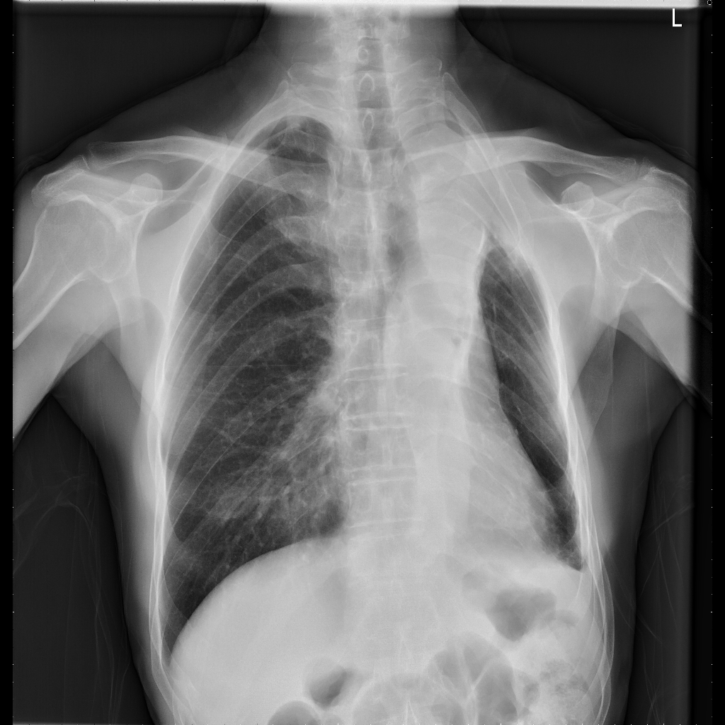 MedFM ChestDR 2023 胸部X射线胸部疾病筛查数据集介绍 - 知乎