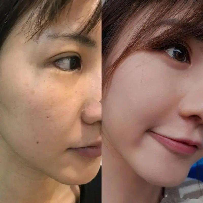 皮秒祛斑要多少钱？祛斑手术需要做几次才能去干净？做了超皮秒祛斑还会长斑吗？