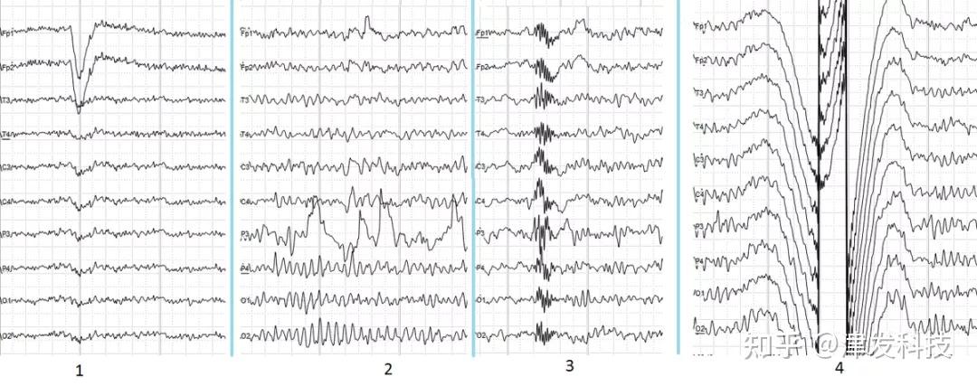 如何提高研究中EEG数据的有效性 - 知乎