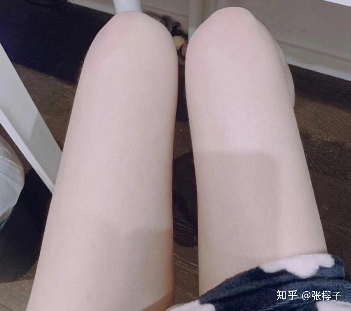 长胖了还长了肥胖纹怎么办？肥胖纹能救吗？”万年 难搞肥胖纹到底应该怎么淡化？内有最全肥胖纹淡化方法和步骤！