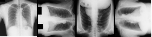 jsrt-directions X 光片方向判断数据集介绍 - 知乎