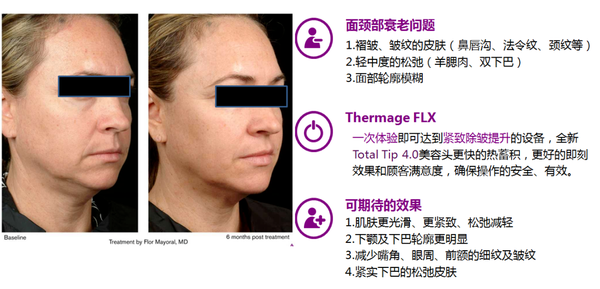 共识解读 |《新一代热玛吉(Thermage FLX)射频紧肤专家共识》解读（1） - 知乎