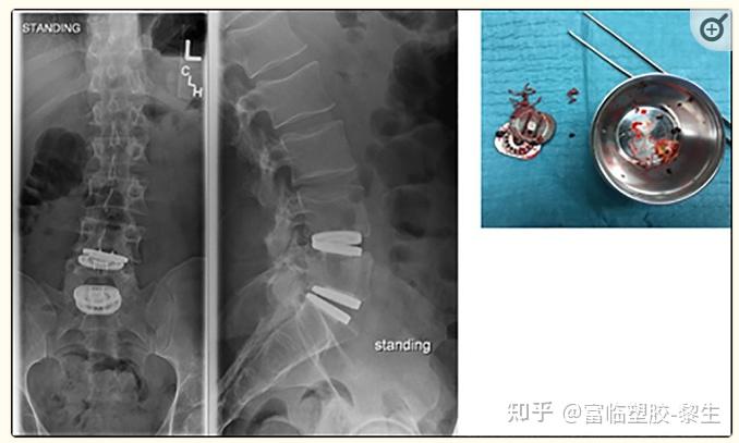 CarboSil制作腰椎和颈椎椎间盘有机硅聚碳酸酯聚氨酯共聚物 - 知乎