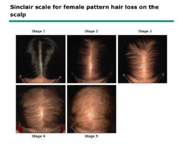 如何辨别自己脱发几级？这份脱发指南一定收藏好 - 知乎
