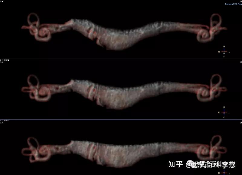 MRI内听道神经及周围血管成像扫描规范（MRTA、IAC） - 知乎