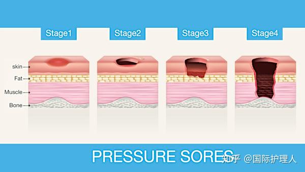 护理知识|区分压力性损伤和湿气相关皮肤损伤（MASD） 的提示 - 知乎