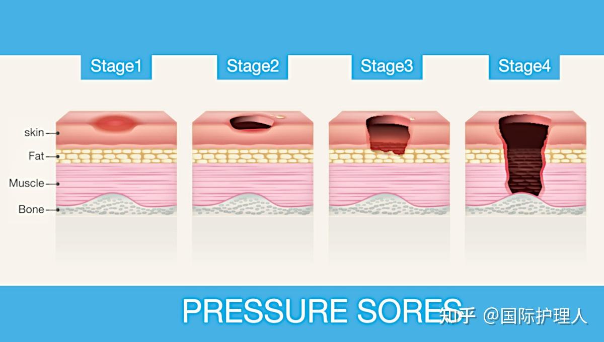 护理知识|区分压力性损伤和湿气相关皮肤损伤（MASD） 的提示 - 知乎