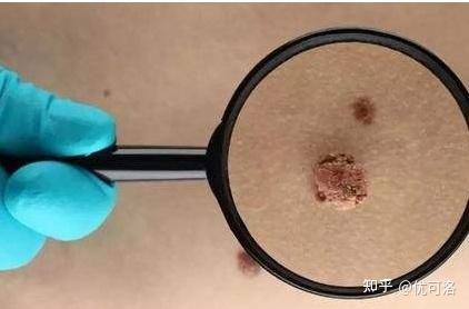 hpv51怎么引起的 - 知乎