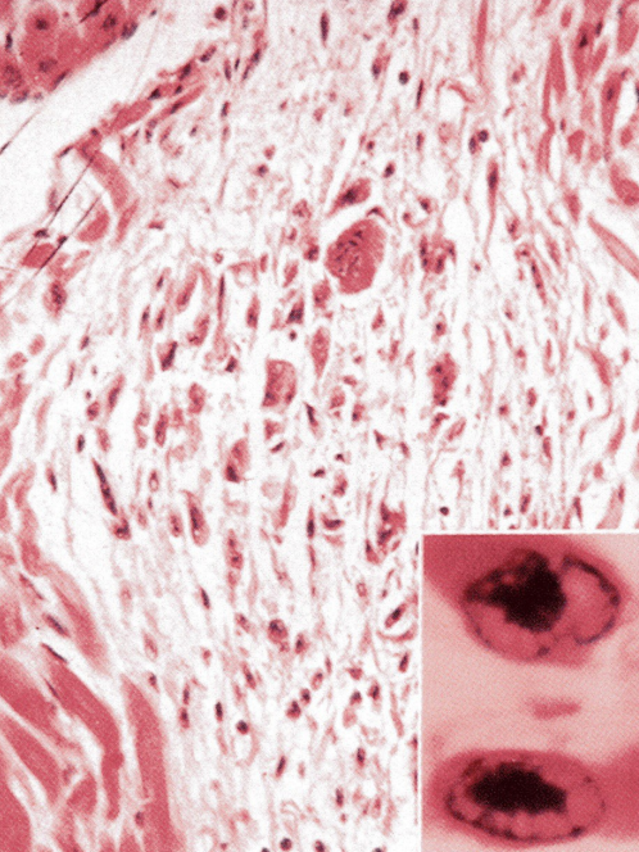 循环病理学：风湿病、风湿性心脏病、风湿性瓣膜病 - 知乎