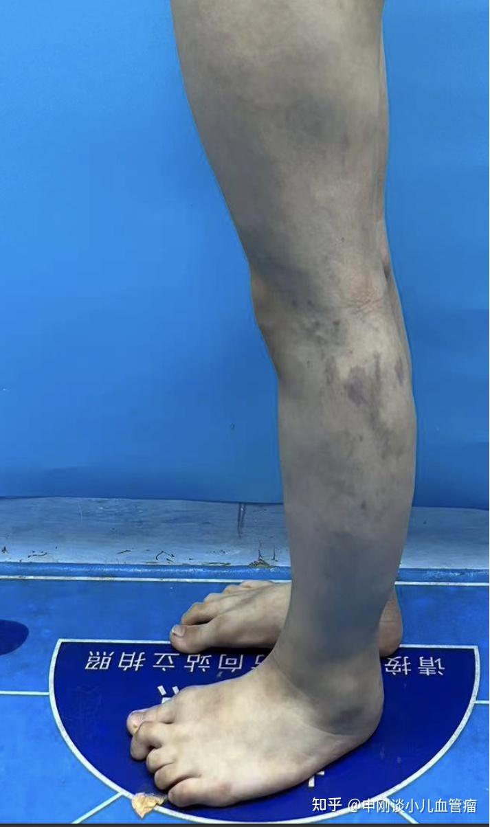 KT综合征(Klippel-Trenaunay syndrome，KTS) 介入治疗 - 知乎