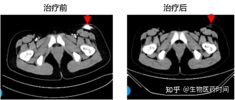 新一代NTRK抑制剂ICP-723治疗实体瘤临床研究病案分享 - 知乎