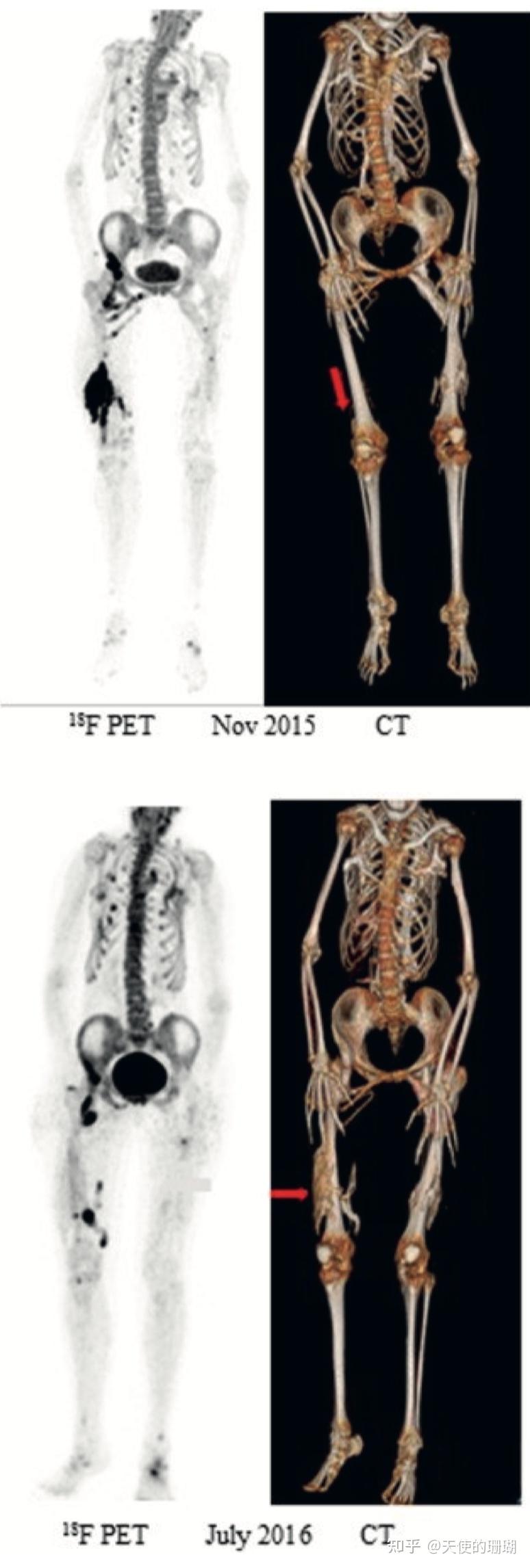 [18F]氟化钠(NaF) PET/CT扫描用于FOP异位骨化的早期标记物 - 知乎