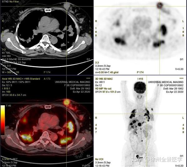 本以为是感冒咳嗽，PET/CT诊断竟是乳腺癌？！ - 知乎