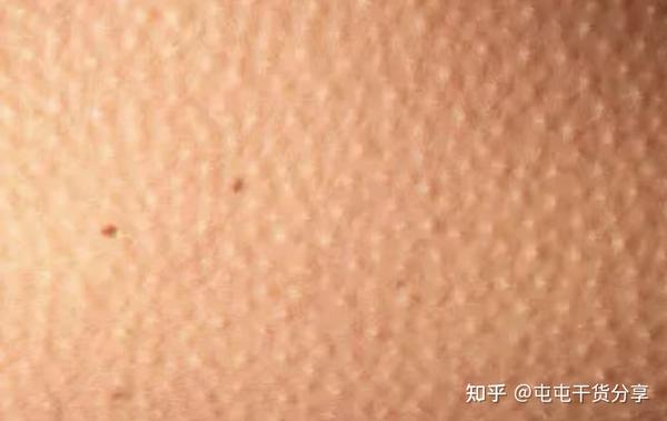 痘痘妹子必备 知乎