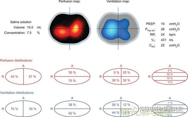 第139期胸部电阻抗断层成像（EIT）的原理、图像分析及临床应用 - 知乎