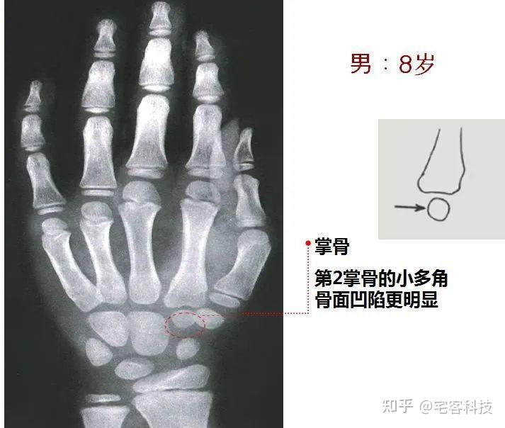 儿童生长发育骨龄图谱丨建议收藏！ - 知乎