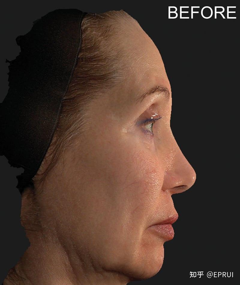 25-45um 医美用CaHA羟基磷灰石微球 - 知乎