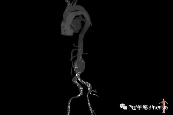 3mensio vascular - 知乎