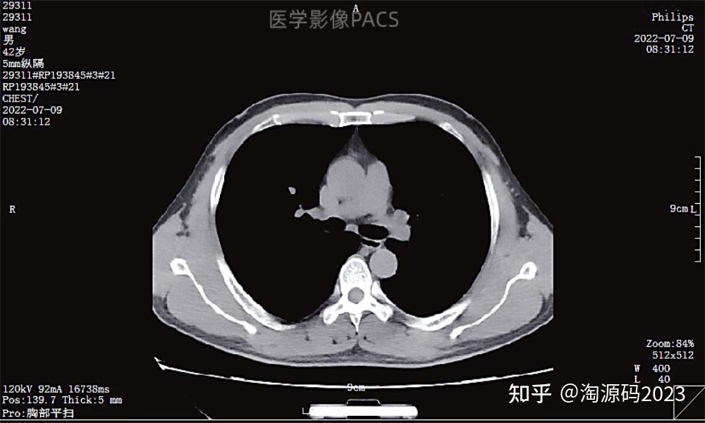 【C++医学影像PACS】CT检查中的三维重建是什么检查？ - 知乎