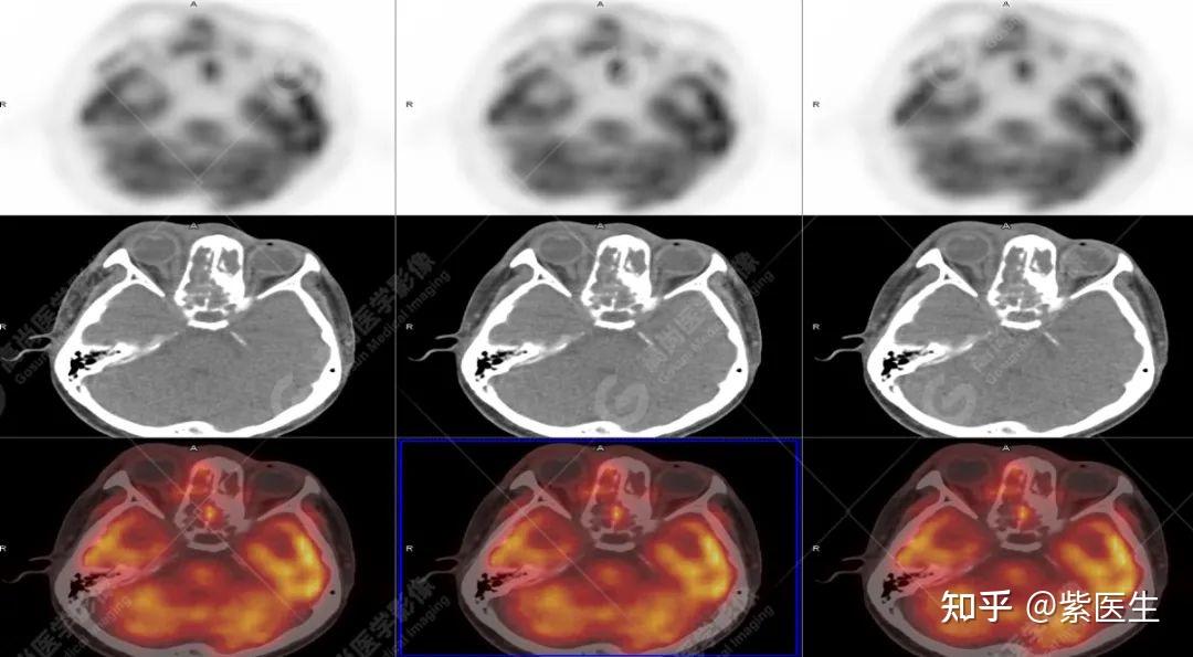 【高尚医学影像病例】PET-CT/MR增强多模态诊断结外NK/T细胞淋巴瘤复发一例 - 知乎