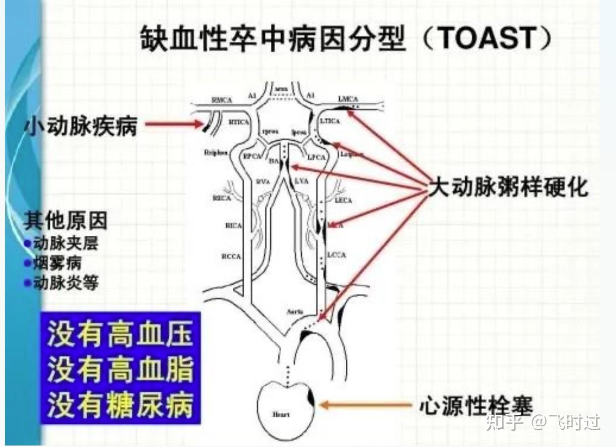 脑卒中的TOAST分型 - 知乎