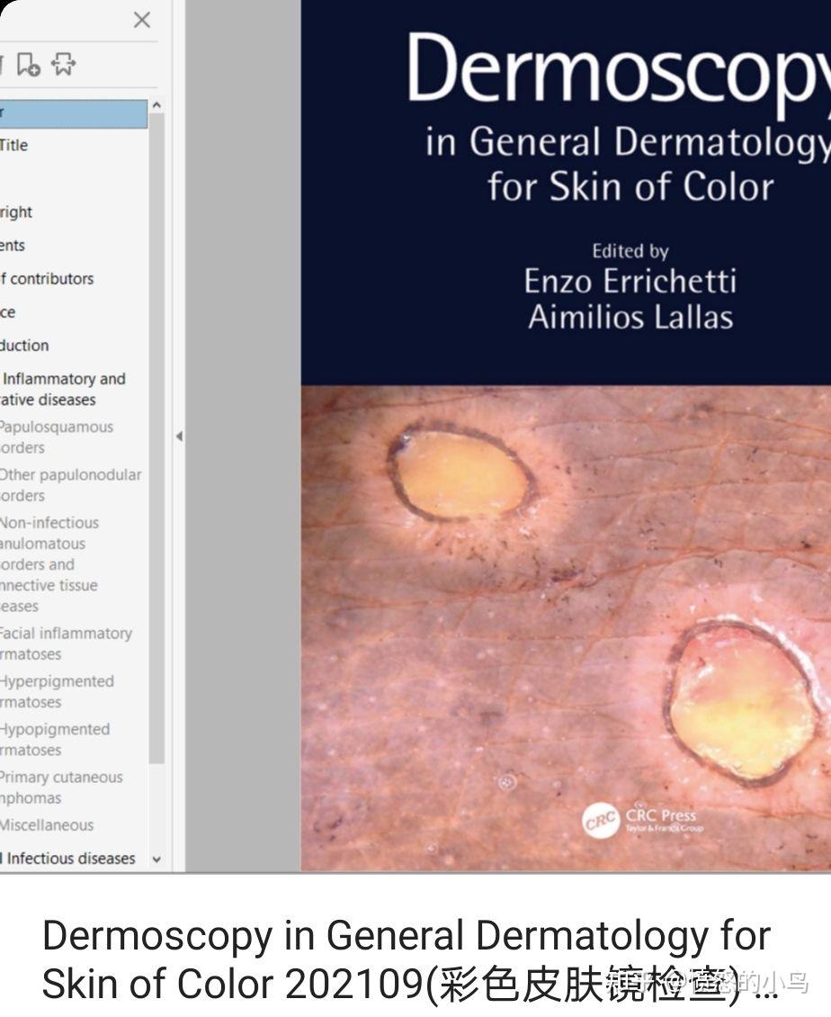Dermoscopy in General Dermatology for Skin of Color 202109(彩色皮肤镜检查) 原版pdf - 知乎