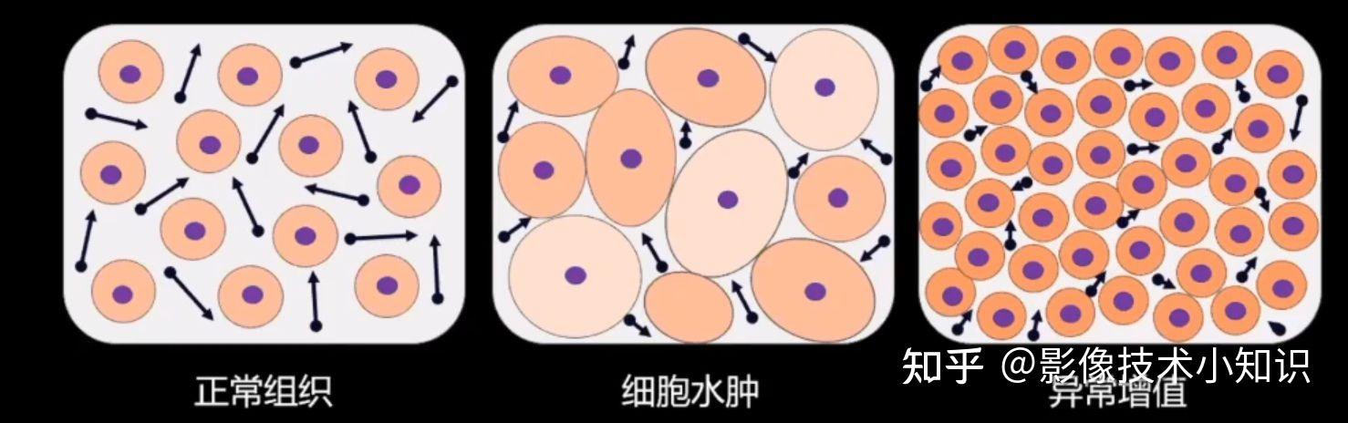 磁共振DWI的原理 - 知乎