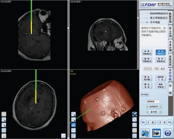 手术导航系统，让医生获得“透视” - 知乎