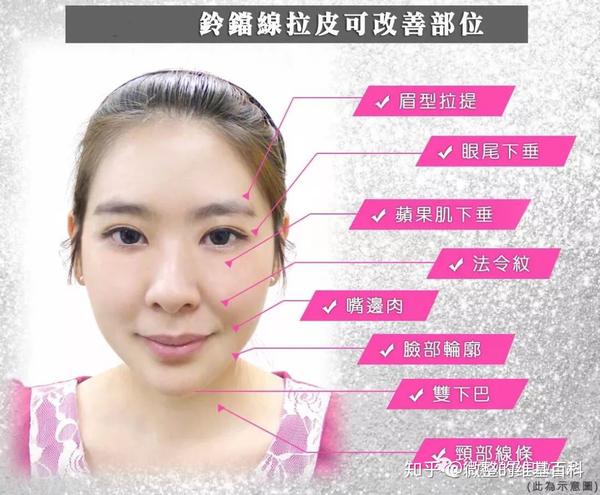 今天我们来聊聊线雕吧，你们只知道PDO/PPDO和PLA以及PLLA吗？史上最全线雕科普包含铃铛线 - 知乎