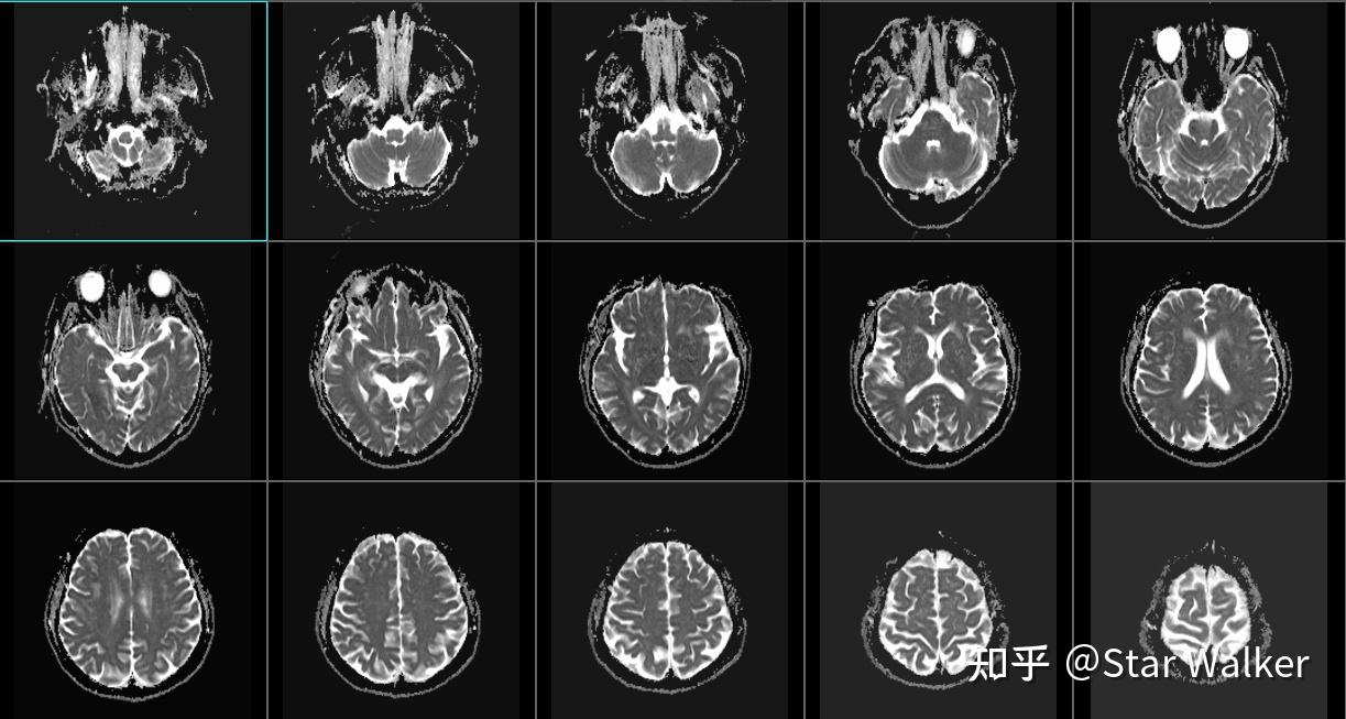 用MeVisLab来计算ADC值，并做对比（上） - 知乎