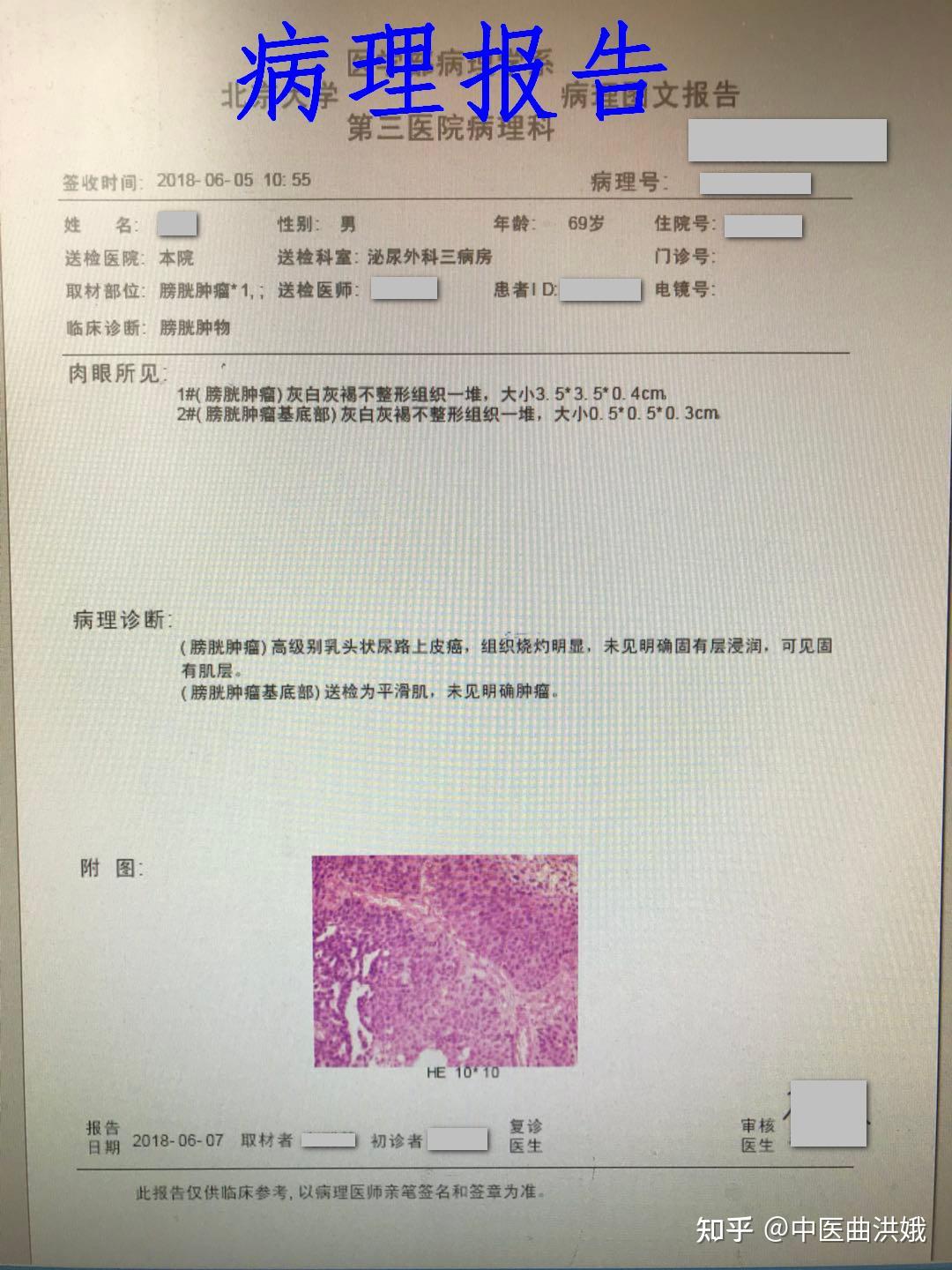 膀胱癌中最常见的高级别多发膀胱癌。 - 知乎