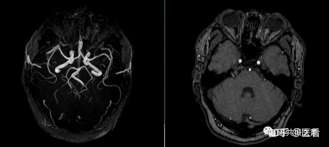 颅内3D TOF-MRA成像中的几个技术要点 - 知乎