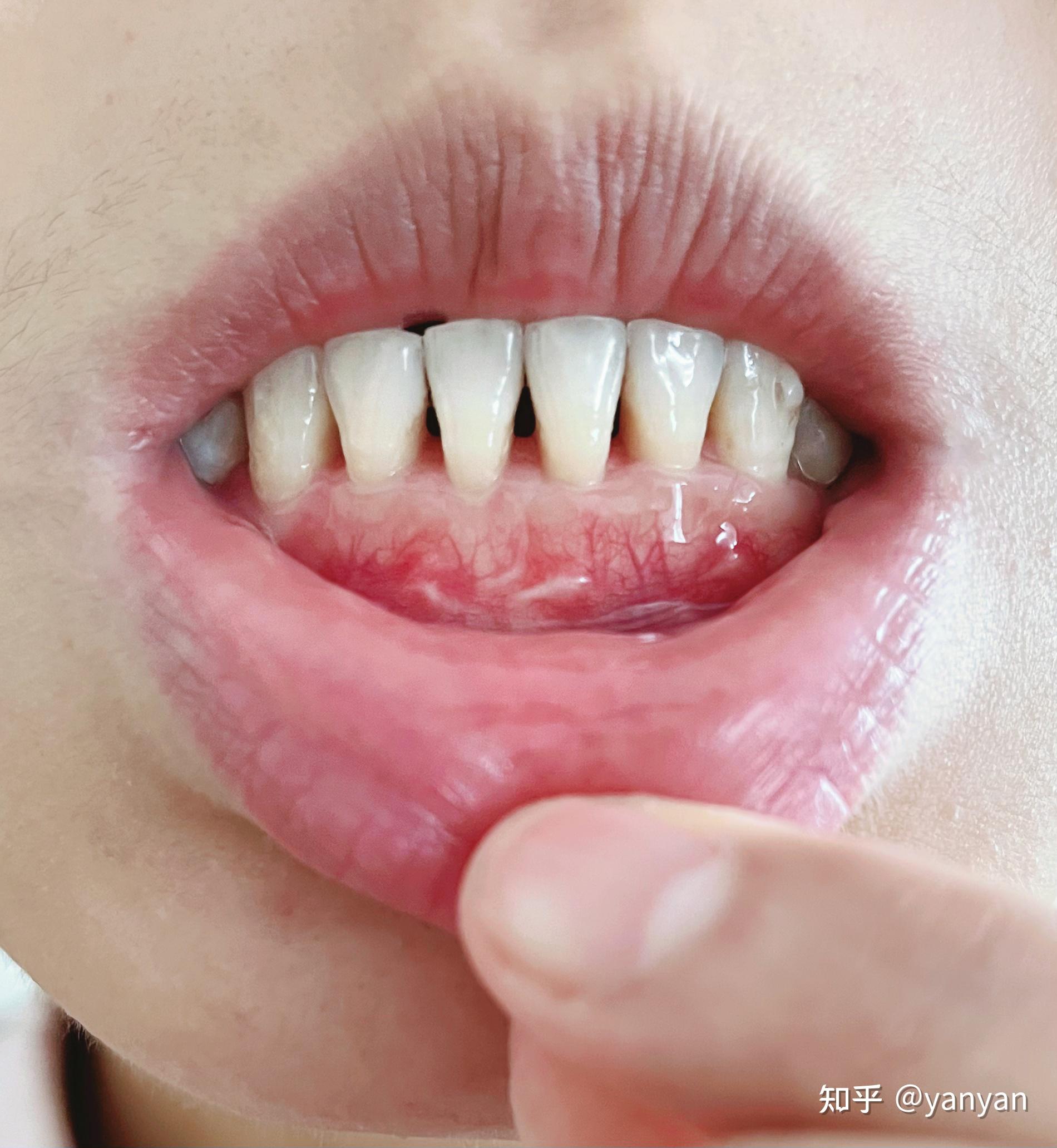 牙周膜龈手术+植骨（PAOO）记录 - 知乎