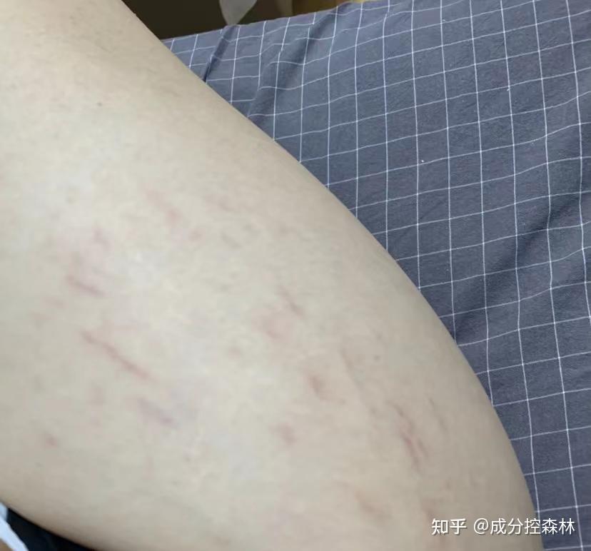 贫民窟肥胖纹女孩自救指南!这款妊娠油好用到空瓶,淡化肥胖纹它真的可以! 知乎