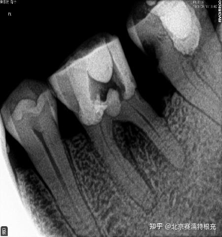 36根管治疗一例 | 黄伟琦医生使用赛濡特C-Root SP充填案例 - 知乎