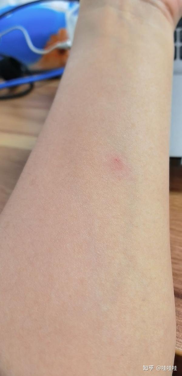 ppd皮试变化过程 - 知乎