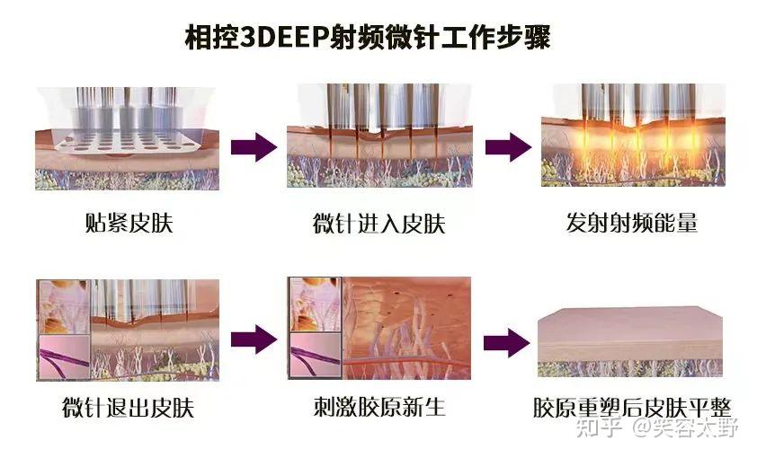 美迪迈EndyMed pro 3Deep 真的能够媲美热玛吉？ - 知乎