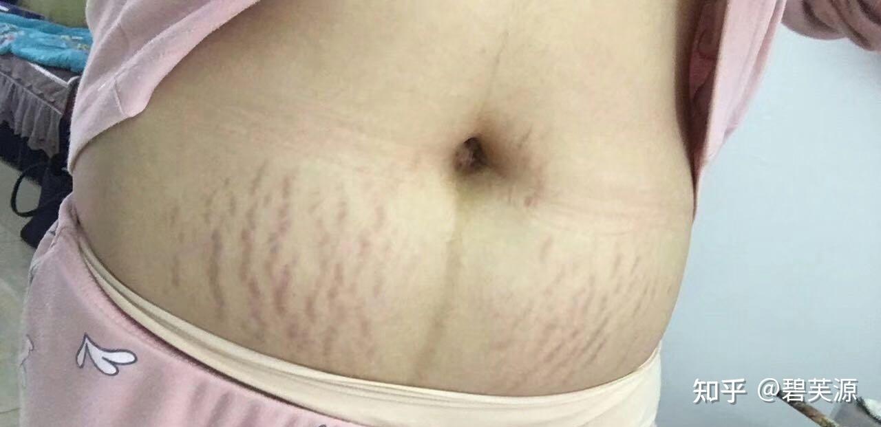 身上红色的妊娠纹有什么办法能够祛除? 知乎
