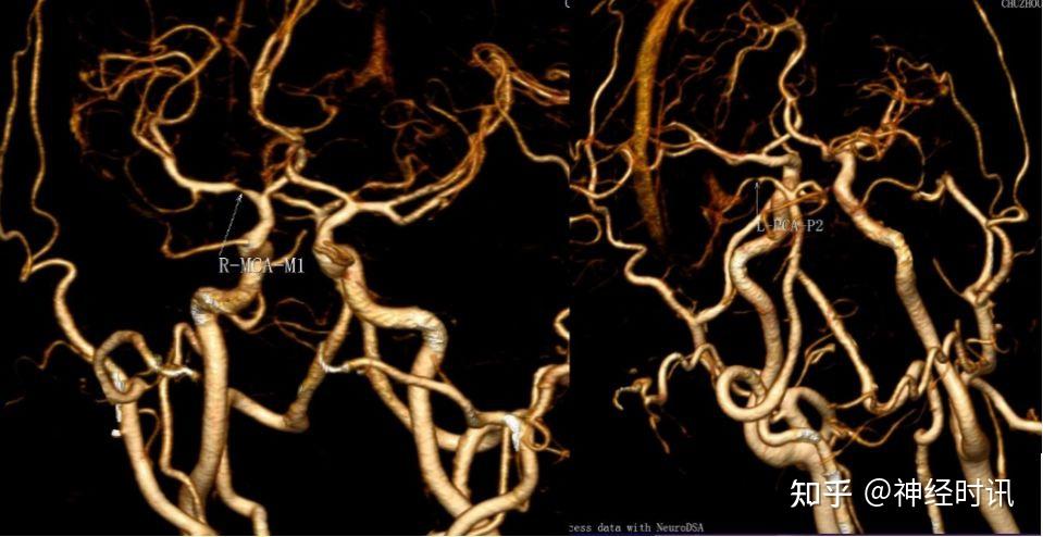 颅脑动脉系统及CTA检查技术，一文读懂 - 知乎