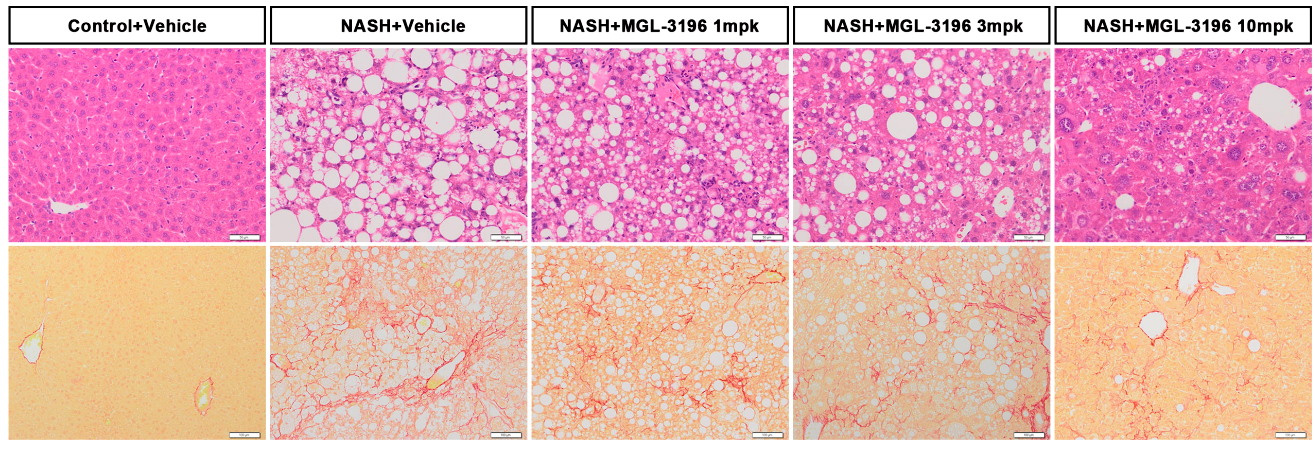 NASH治疗药物迎来高光时刻：Resmetirom三期进展优异 - 知乎