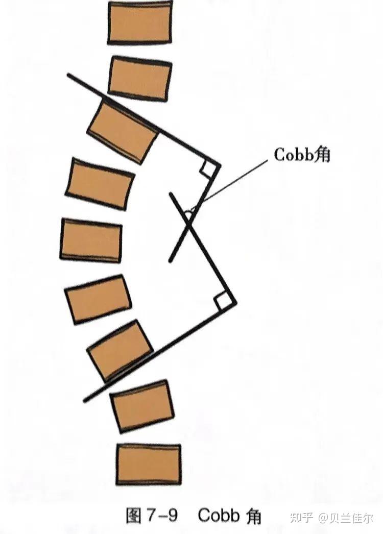 【体态评估】脊柱侧弯姿势评估与解剖学分析 - 知乎