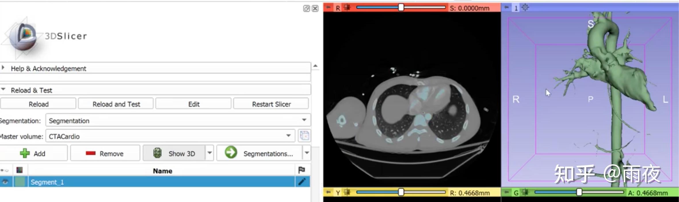 3D Slicer 重建胸主动脉 - 知乎