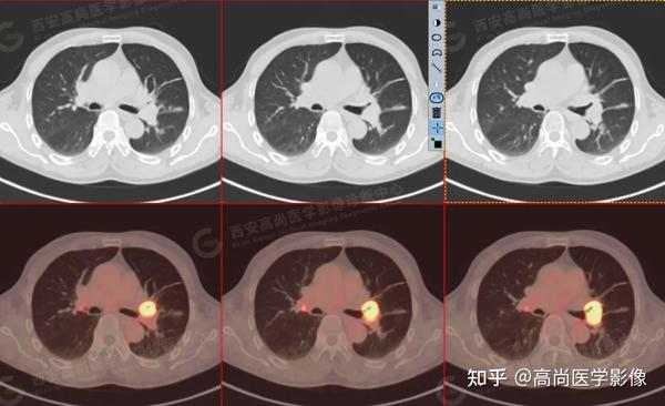 PET/CT病例：肺鳞癌5例【高尚医学影像】 - 知乎