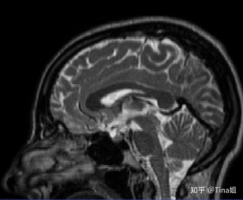 介绍一款 MRI&CT 图像预处理强大工具--FSL - 知乎
