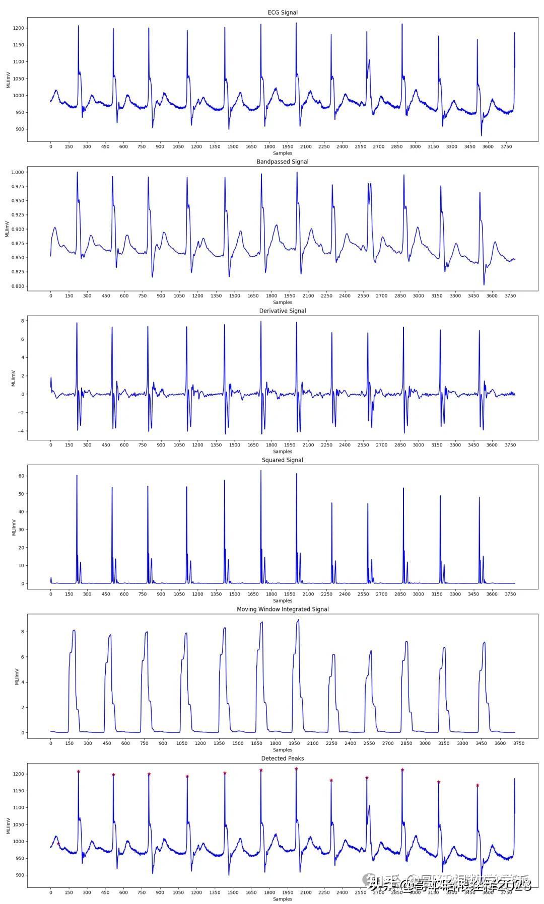 心电信号ECG处理分析（滤波降噪，QRS波检测等，Python） - 知乎