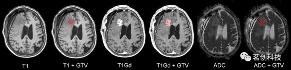 磁共振弥散成像(dMRI)分析方法 - 知乎