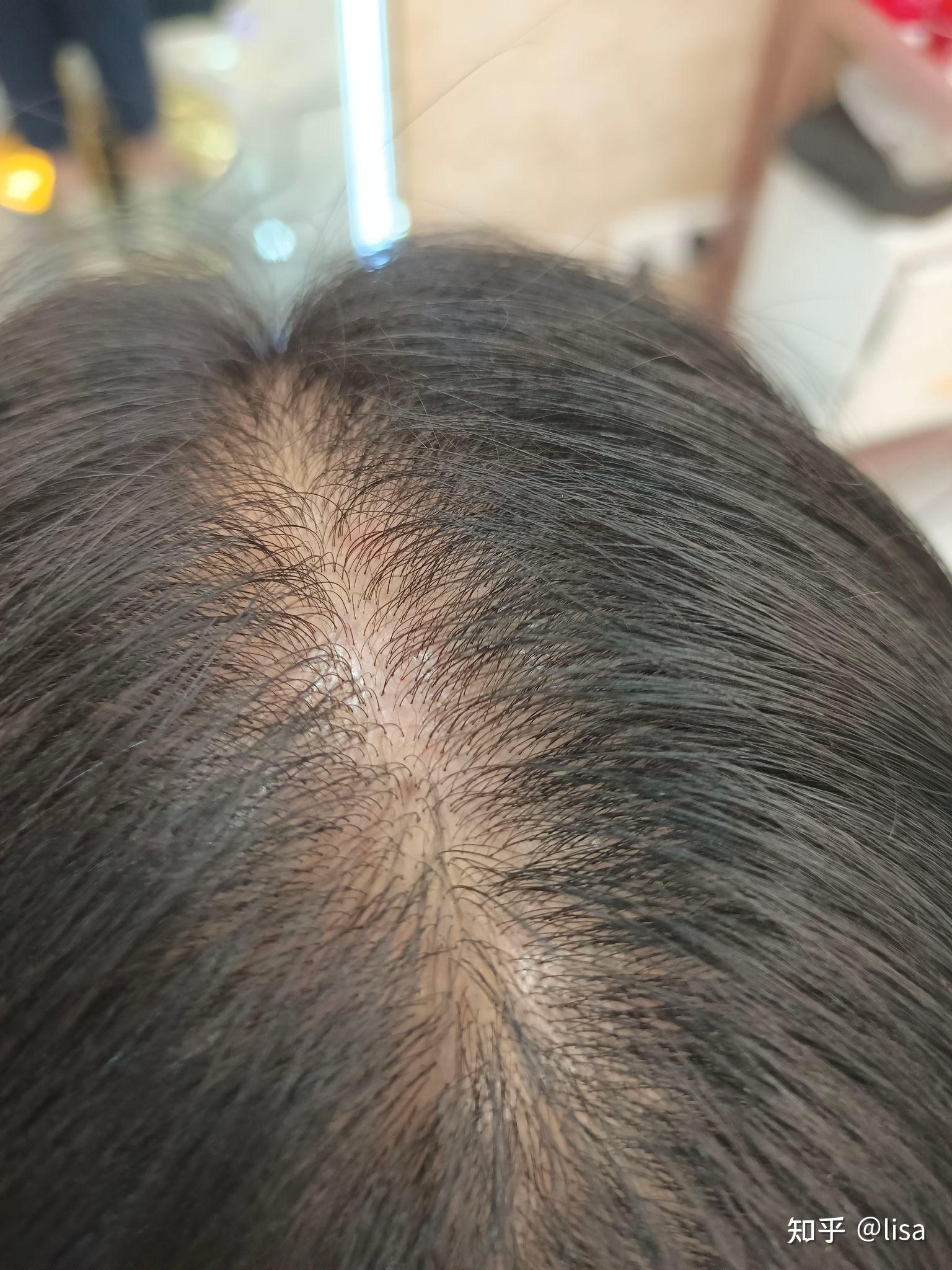 脂溢性脱发－广东省中医院治疗之旅 - 知乎