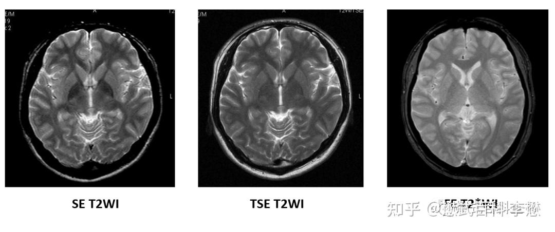 磁共振序列之T2*WI - 知乎